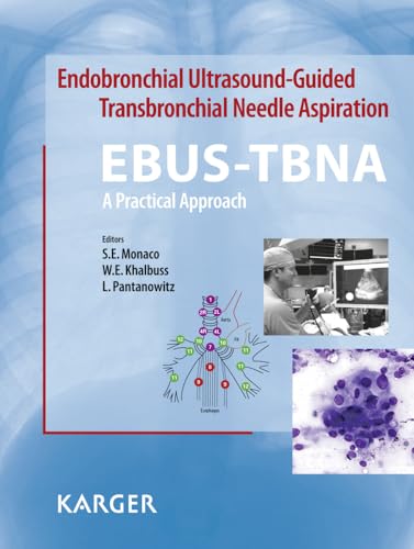 Endobronchial Ultrasound-Guided Transbronchial Needle Aspiration (EBUS ...
