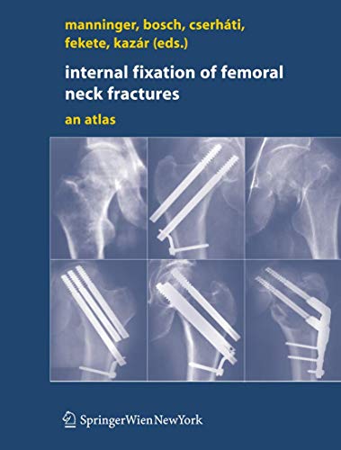 Internal fixation of femoral neck fractures By Ulrich Bosch | World of ...